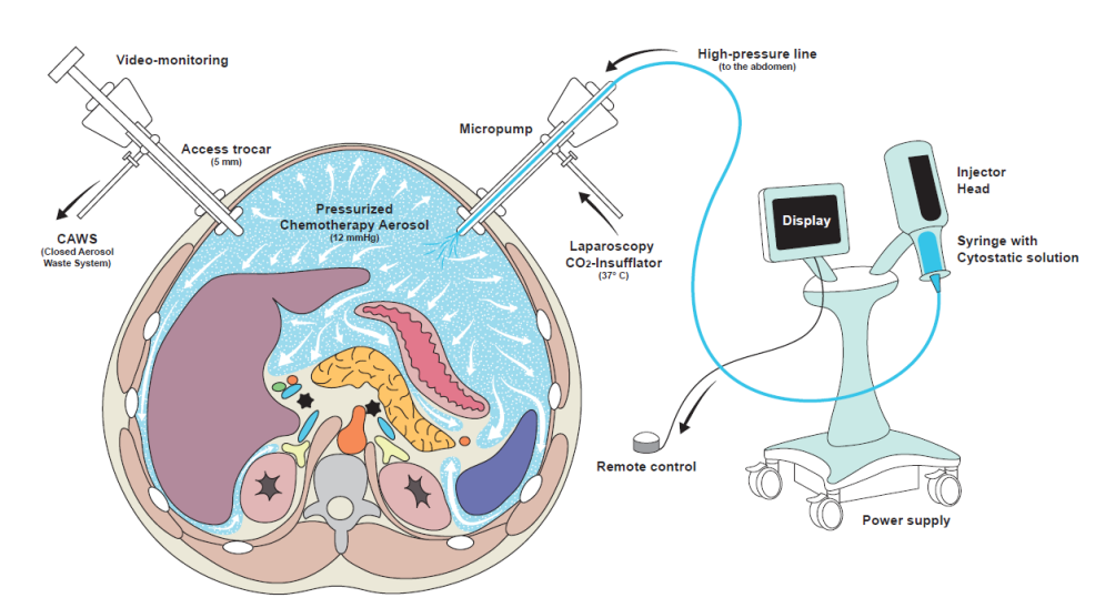 Pipac Cancer Treatment Center | Pipac Therapy | Pipac Cost | Pipac ...
